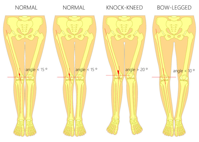 Guided growth surgery; This is What to expect with and after guided ...